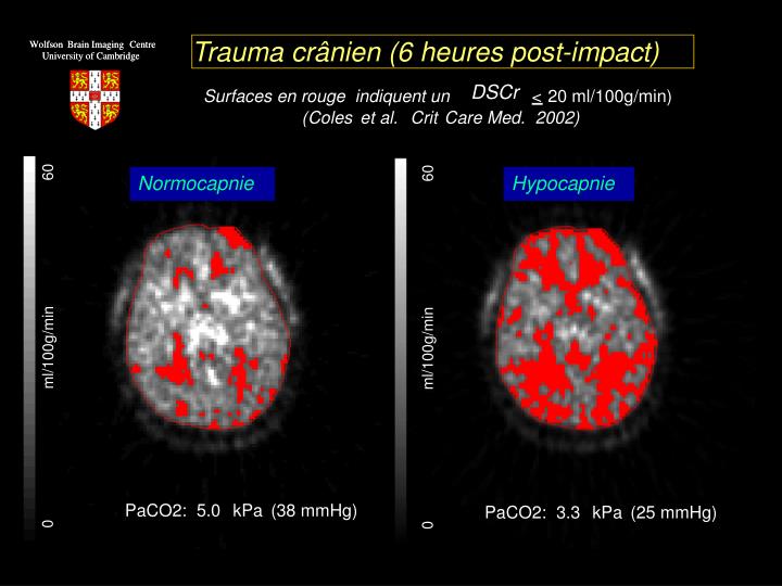 PPT - PHYSIOPATHOLOGIE DE L’HYPERTENSION INTRA-CRANIENNE (HTIC ...