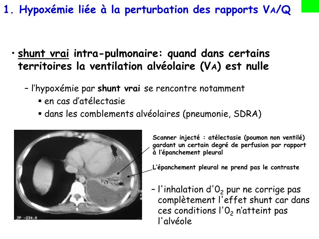 PPT - Insuffisance Respiratoire Chronique Définitions et ...