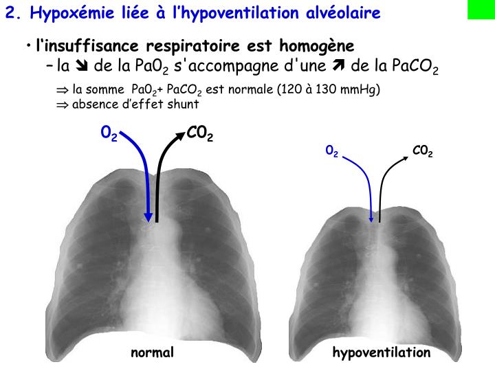 PPT - Insuffisance Respiratoire Chronique Définitions et ...