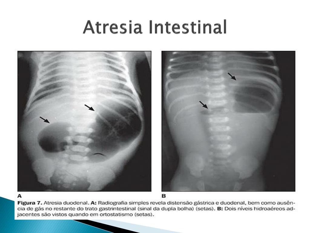 PPT - PATOLOGIAS CIRÚRGICAS EM NEONATOLOGIA PowerPoint Presentation ...