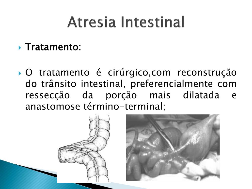 PPT - PATOLOGIAS CIRÚRGICAS EM NEONATOLOGIA PowerPoint Presentation ...