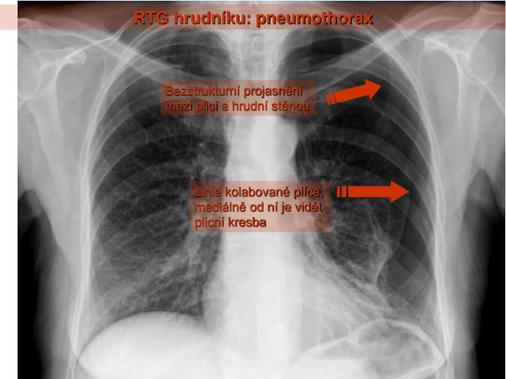 PPT - RTG hrudníku: pleurální výpotek vpravo PowerPoint Presentation ...