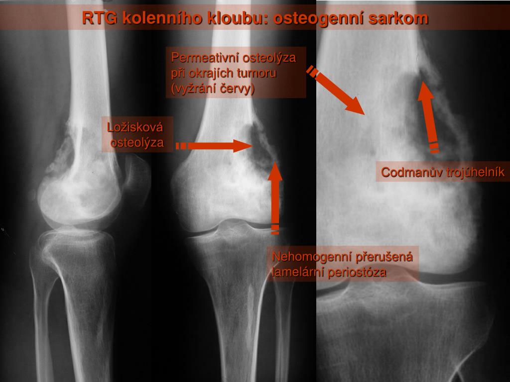 PPT - RTG hrudníku: pleurální výpotek vpravo PowerPoint Presentation ...