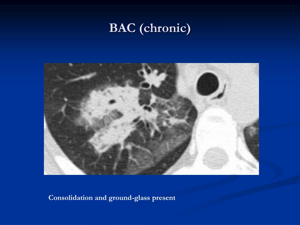 PPT - Alveolar / Airspace lung disease Acute,chronic and ground glass ...