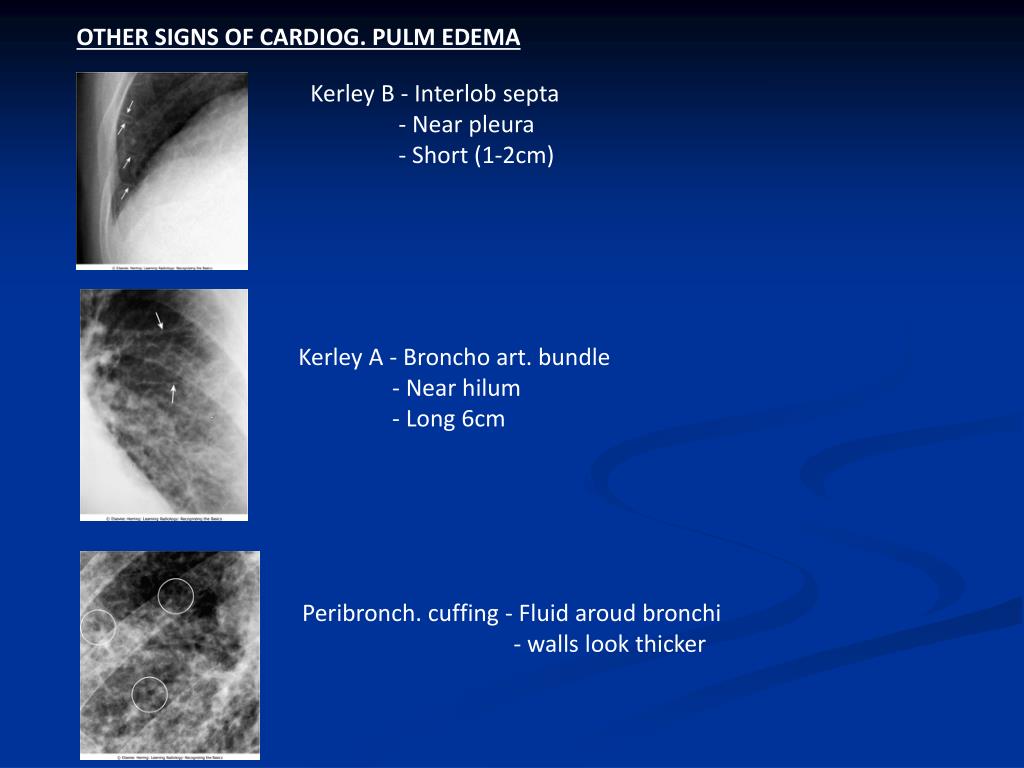 PPT - Alveolar / Airspace lung disease Acute,chronic and ground glass ...