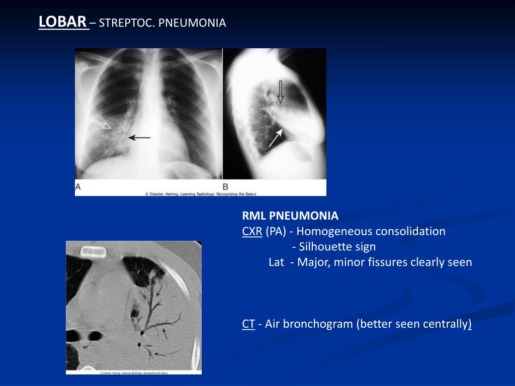PPT - Alveolar / Airspace lung disease Acute,chronic and ground glass ...