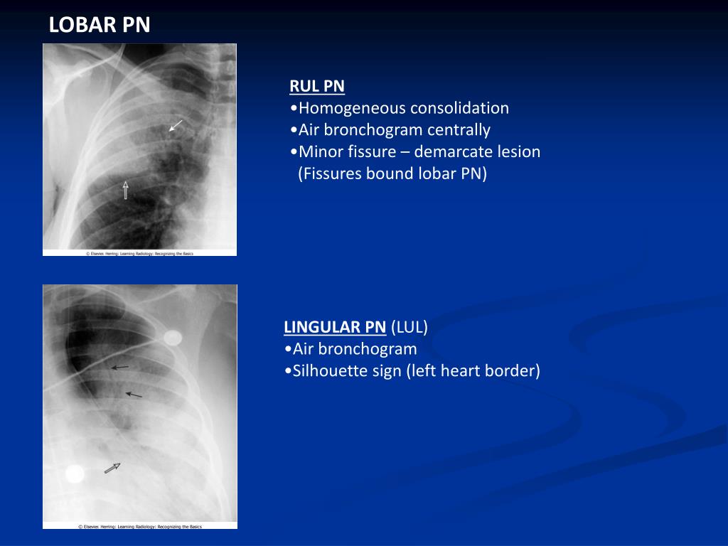 PPT - Alveolar / Airspace lung disease Acute,chronic and ground glass ...
