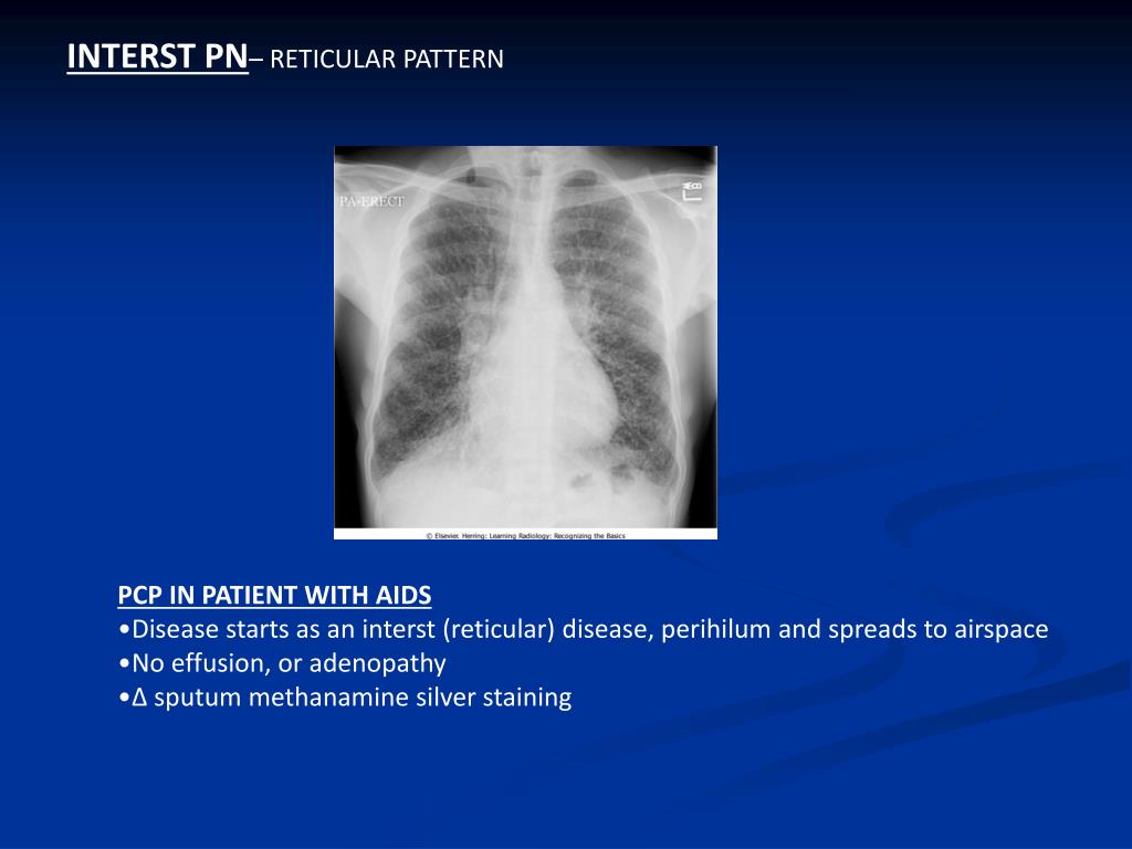 PPT - Alveolar / Airspace lung disease Acute,chronic and ground glass ...