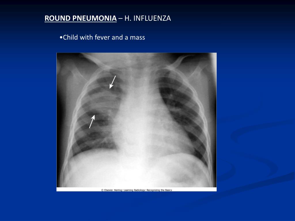 PPT - Alveolar / Airspace lung disease Acute,chronic and ground glass ...