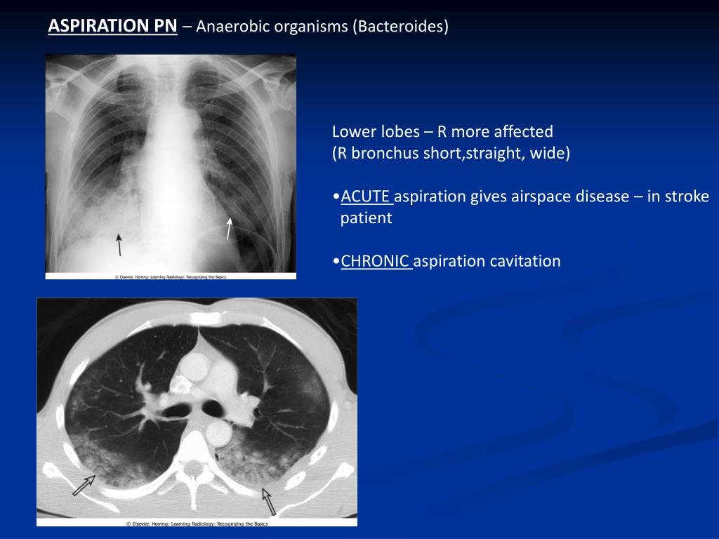PPT - Alveolar / Airspace lung disease Acute,chronic and ground glass ...