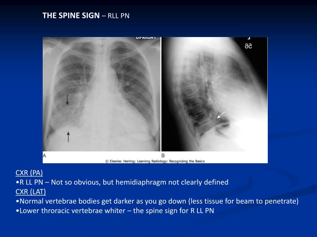 PPT - Alveolar / Airspace lung disease Acute,chronic and ground glass ...