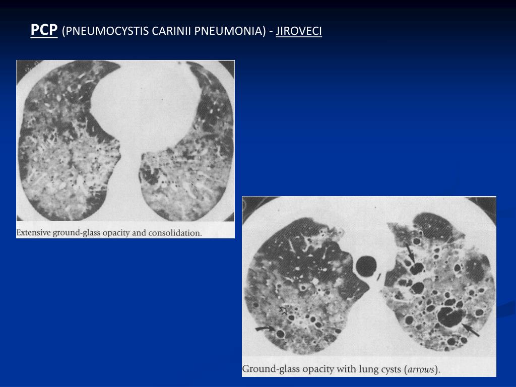 PPT - Alveolar / Airspace lung disease Acute,chronic and ground glass ...