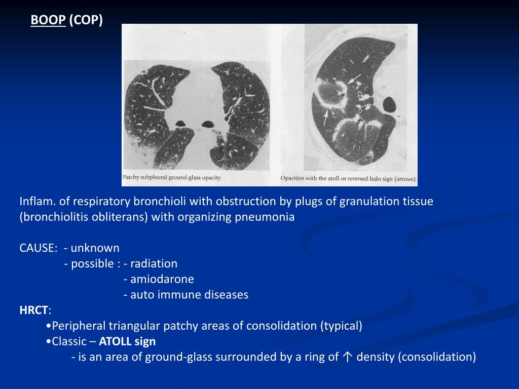PPT - Alveolar / Airspace lung disease Acute,chronic and ground glass ...