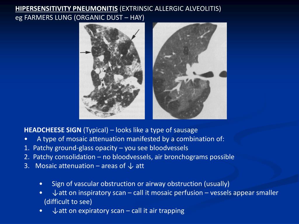 PPT - Alveolar / Airspace lung disease Acute,chronic and ground glass ...