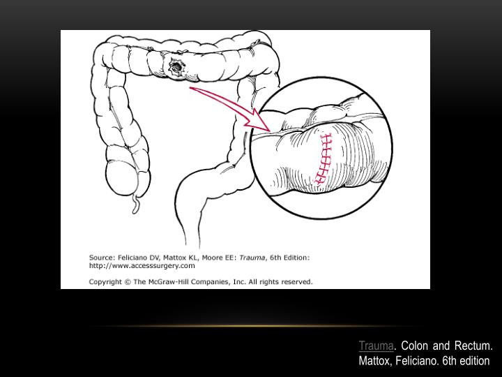 PPT - TRAUMA DE COLON PowerPoint Presentation - ID:3534662