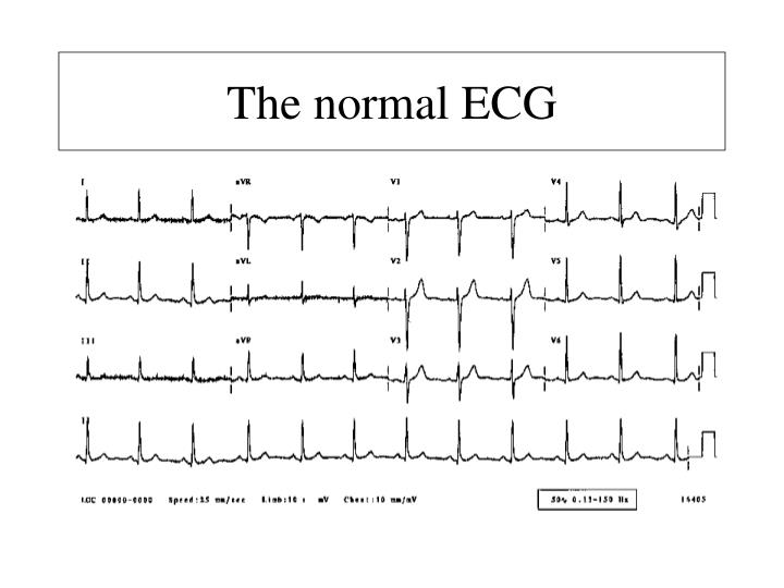 PPT - The normal ECG PowerPoint Presentation, free download - ID:3536497