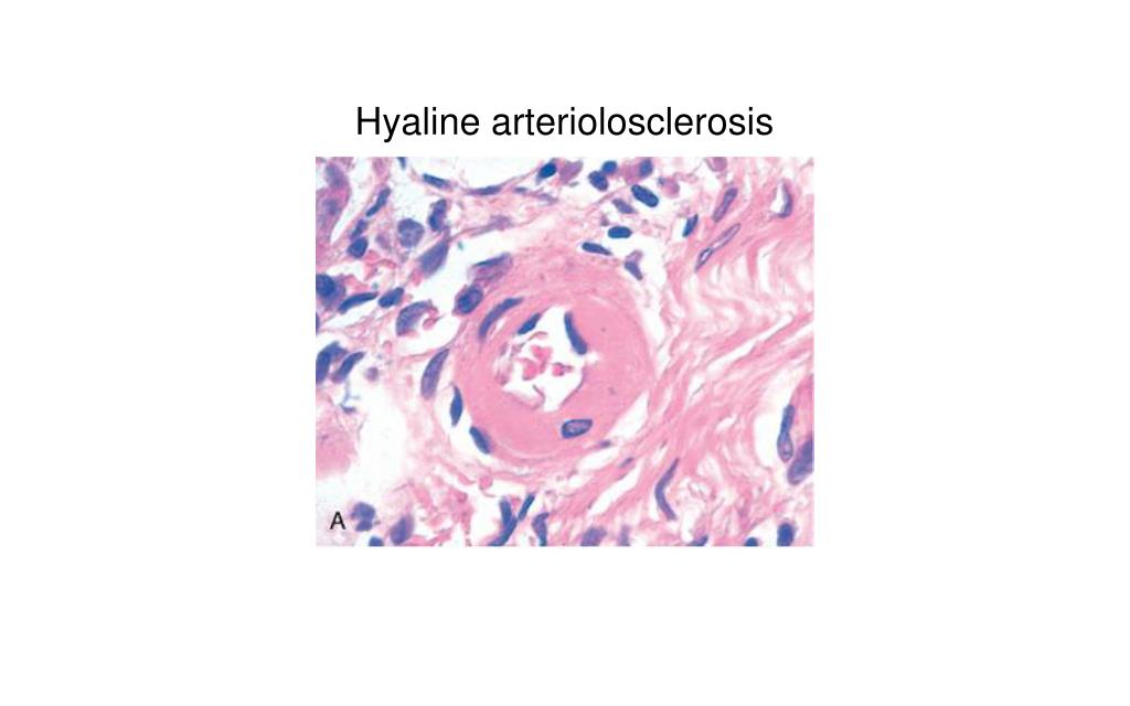 PPT - Hypertensive Vascular Disease Hypertensive Heart Disease ...