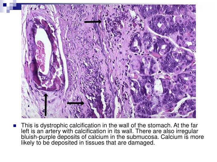 PPT - Pathologic Calcification PowerPoint Presentation - ID:3545884