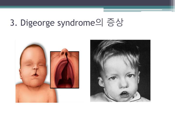 PPT - DiGeorge syndrome ( CATCH 22 ) PowerPoint Presentation - ID:3547561