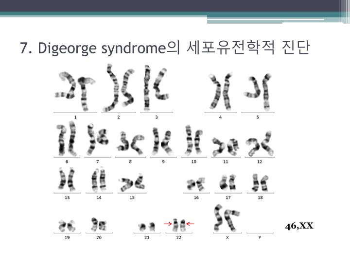 PPT - DiGeorge syndrome ( CATCH 22 ) PowerPoint Presentation - ID:3547561