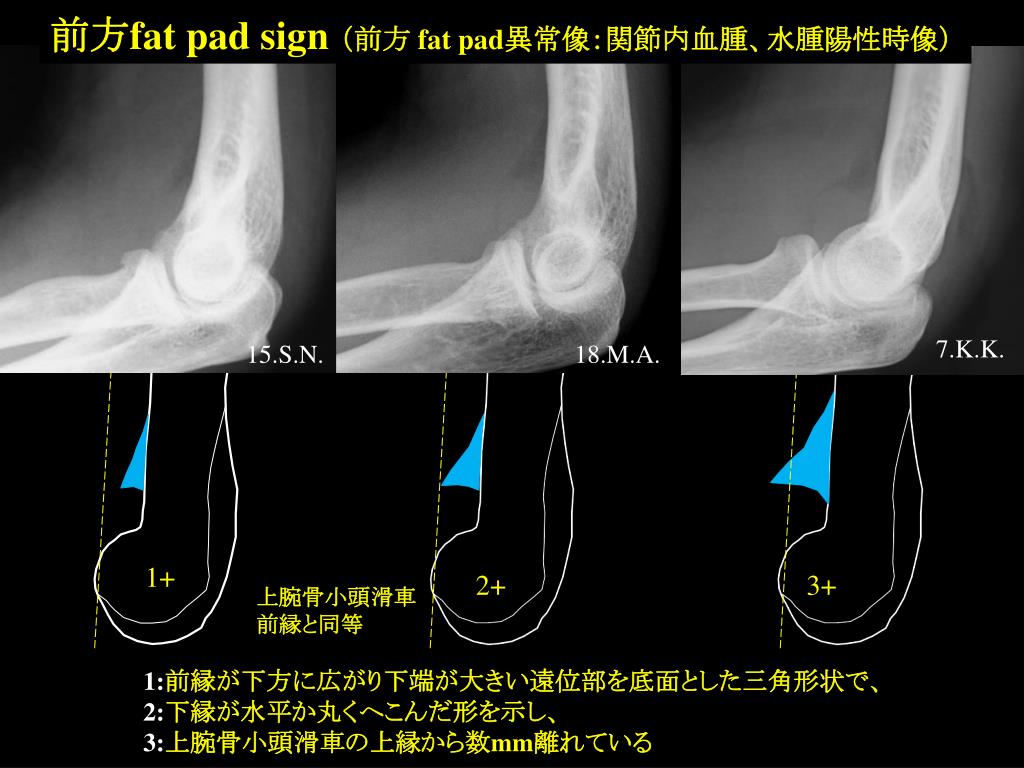 PPT - 肘関節における 前方 fat pad の正常像と 前方 fat pad sign （関節内血腫、水腫陽性像） PowerPoint ...