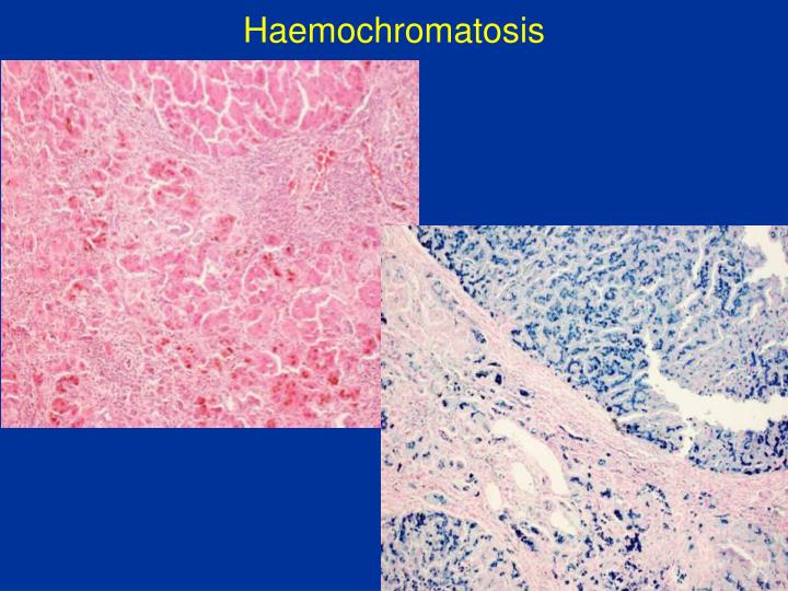 PPT - PATHOLOGY OF THE LIVER PowerPoint Presentation - ID:3551011