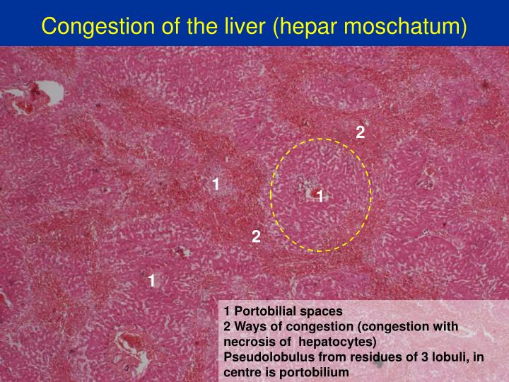 PPT - PATHOLOGY OF THE LIVER PowerPoint Presentation - ID:3551011