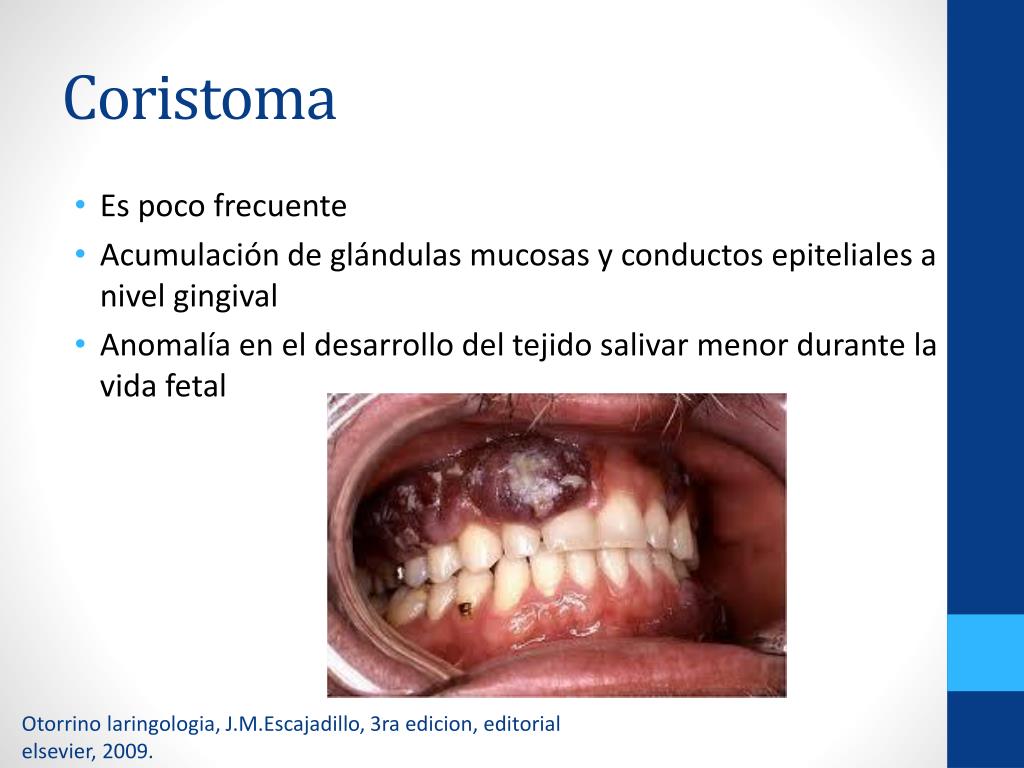 PPT - TUMORES BENIGNOS DE GLÁNDULAS SALIVALES PowerPoint Presentation ...