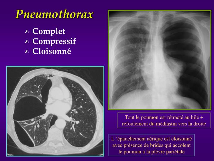 PPT - Radiologie du thorax Sémiologie EIA Pneumologie - PCEM2 Partie 1 ...