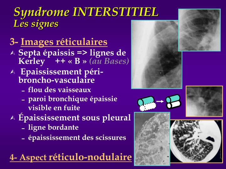 PPT - Radiologie du thorax Sémiologie EIA Pneumologie - PCEM2 Partie 1 ...