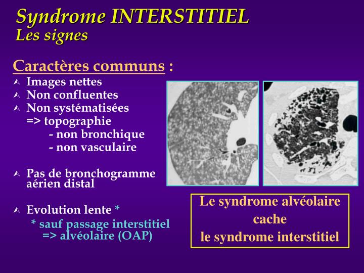 PPT - Radiologie du thorax Sémiologie EIA Pneumologie - PCEM2 Partie 1 ...