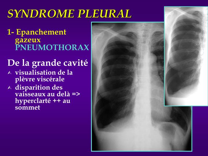 PPT - Radiologie du thorax Sémiologie EIA Pneumologie - PCEM2 Partie 1 ...