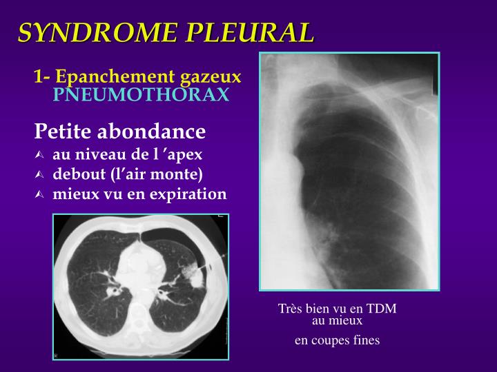 PPT - Radiologie du thorax Sémiologie EIA Pneumologie - PCEM2 Partie 1 ...