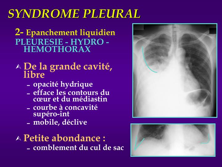 PPT - Radiologie du thorax Sémiologie EIA Pneumologie - PCEM2 Partie 1 ...