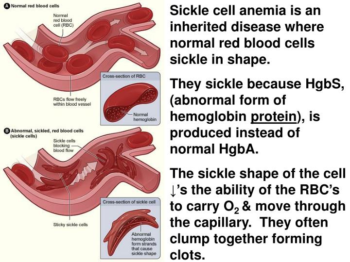 PPT - Sickle cell anemia is an inherited disease where normal red blood ...