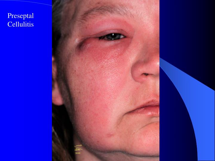 PPT - PERIORBITAL CELLULITIS PowerPoint Presentation - ID:3553901