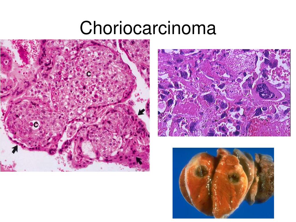 PPT - Campbell’s Chapter 29 Neoplasms of the Testis Brent Zamzow D.O ...