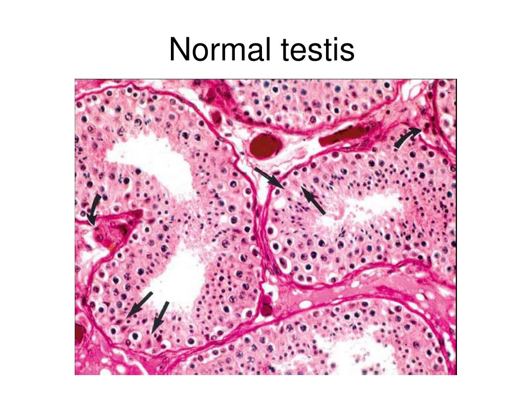 PPT - Campbell’s Chapter 29 Neoplasms of the Testis Brent Zamzow D.O ...