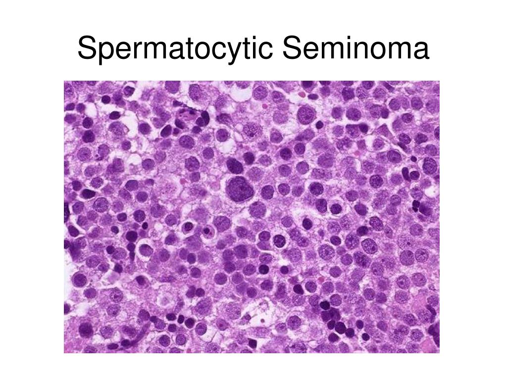 PPT - Campbell’s Chapter 29 Neoplasms of the Testis Brent Zamzow D.O ...