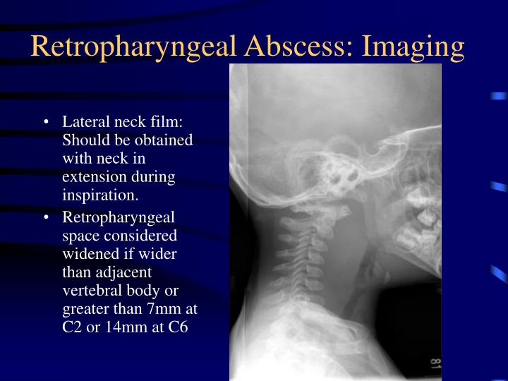 Radiology Peritonsillar Abscess