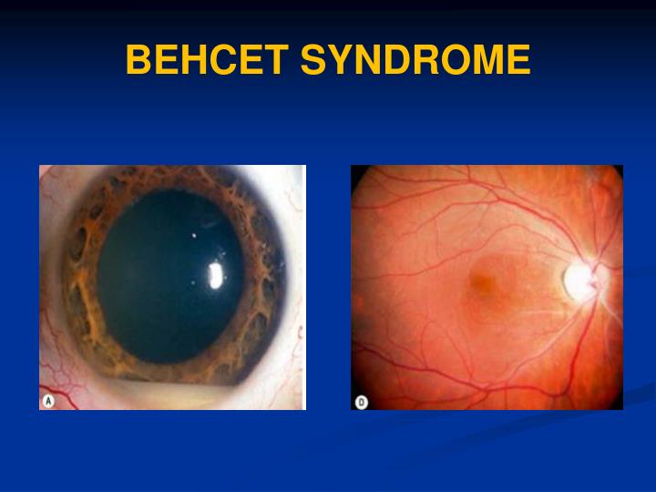 PPT - RED EYE- UVEITIS PowerPoint Presentation - ID:3556322
