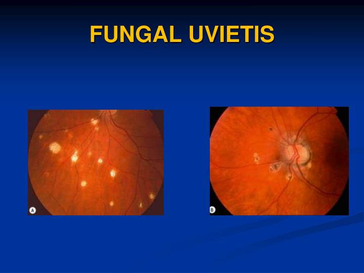 PPT - RED EYE- UVEITIS PowerPoint Presentation - ID:3556322