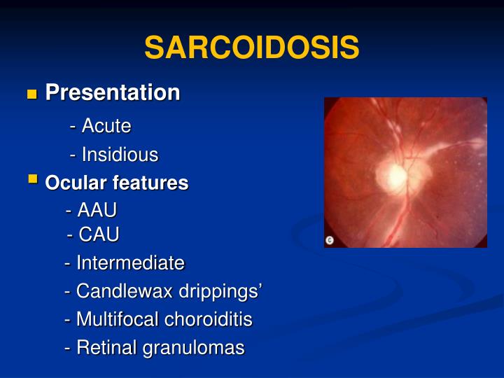 PPT - RED EYE- UVEITIS PowerPoint Presentation - ID:3556322