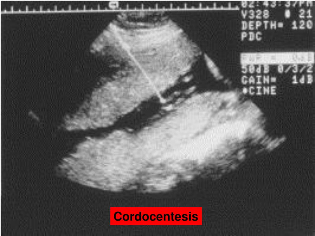 PPT - Alloimmune Hemolytic Disease Of The Fetus / Newborn: Rh ...