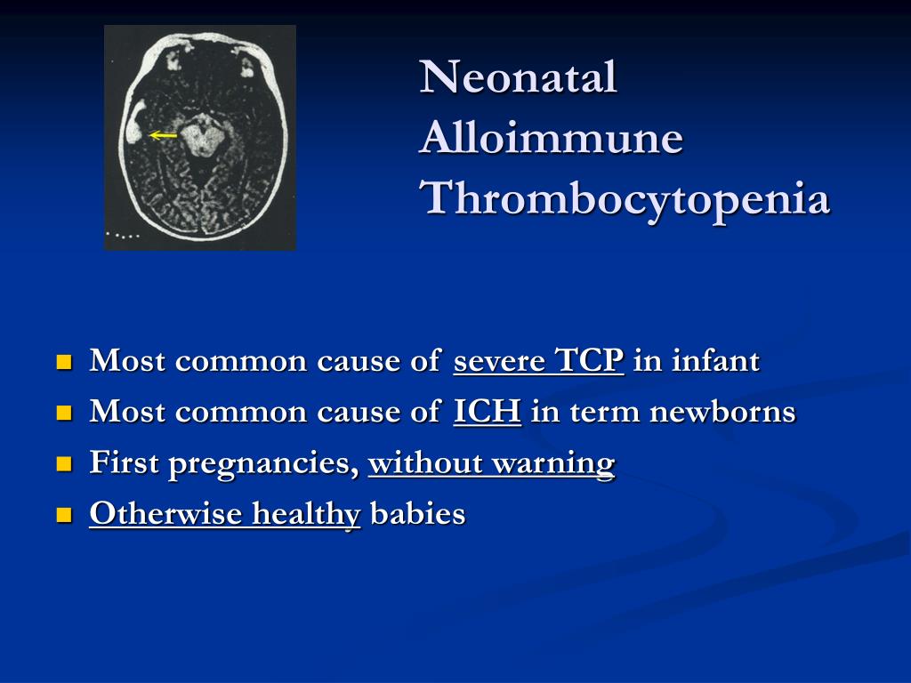 Ppt Neonatal Alloimmune Thrombocytopenia Diagnosis Management