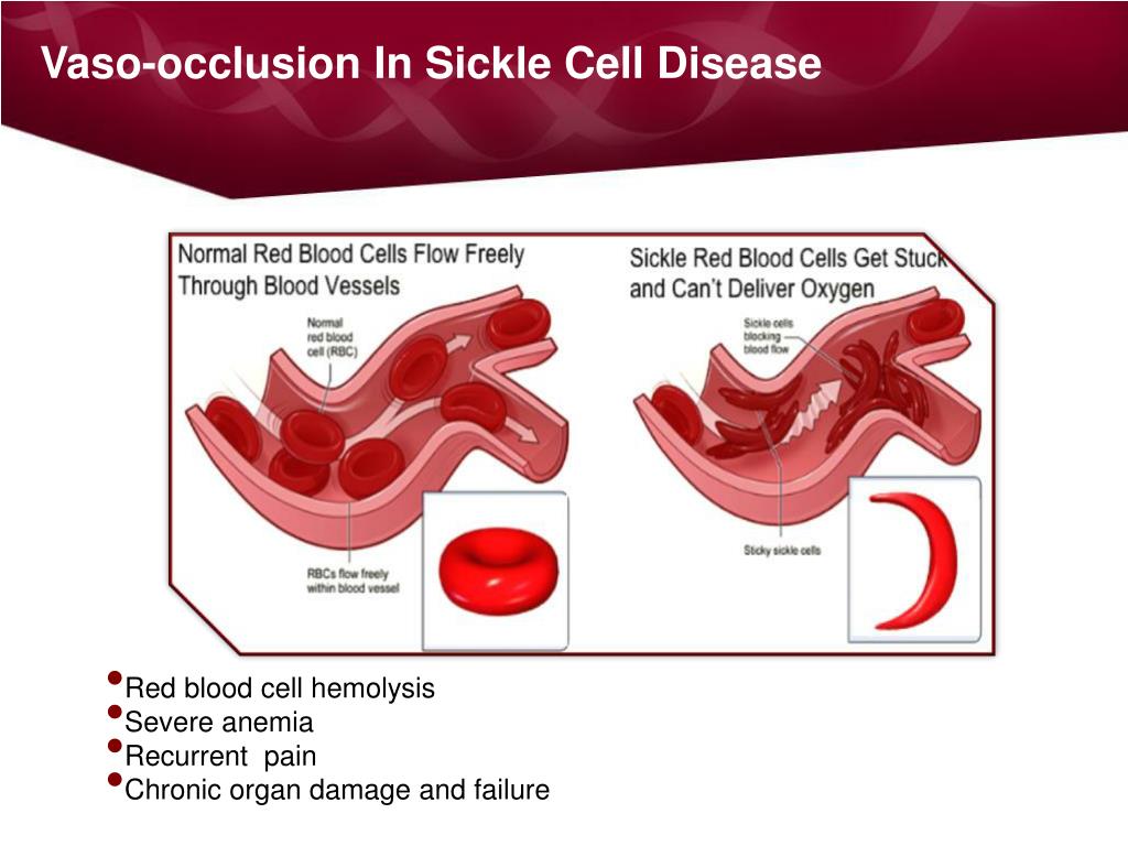 PPT - Sickle Cell Disease Research in the Genome Era PowerPoint ...