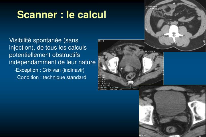 PPT - Sémiologie radiologique Appareil urinaire /génital masculin ...