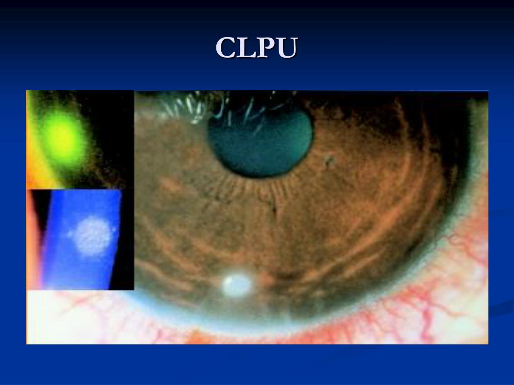 PPT - Infectious Keratitis: Differential Diagnosis & Clinical ...