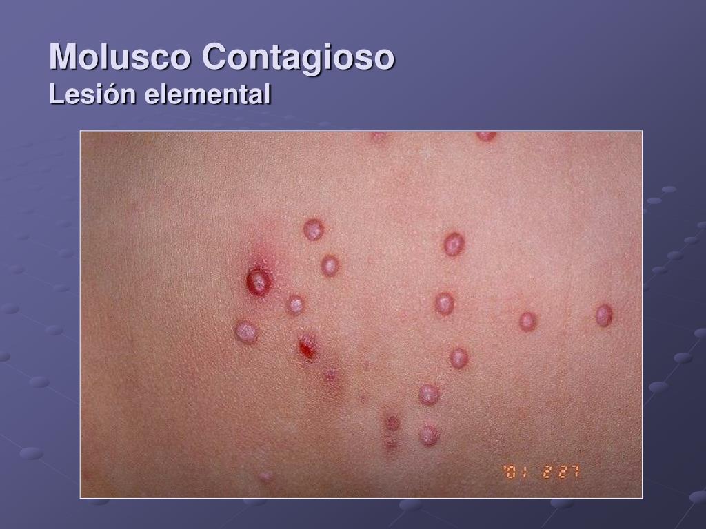 PPT - Virosis cutáneas y Micosis superficiales PowerPoint Presentation ...
