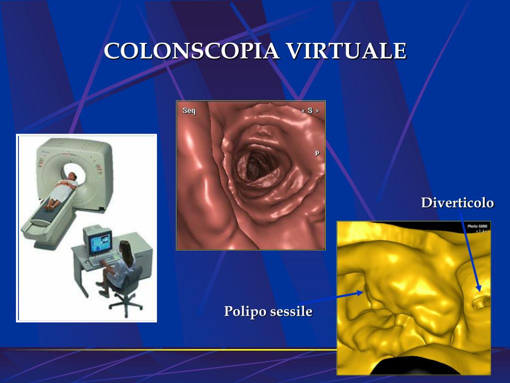 PPT - Sindrome del Giunto Pielo Ureterale: attuali orientamenti ...